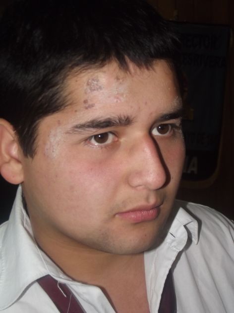 Estudiante de Valdivia denunció haber sufrido quemaduras por líquido de ...