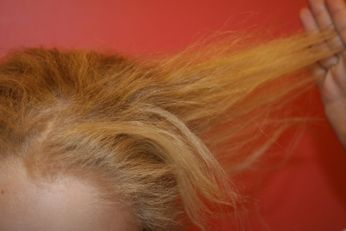 Síndrome del pelo impeinable: la rara anomalía que padecen unas 100 ...