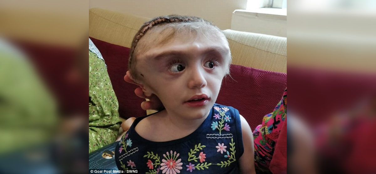 Reducen el cráneo de una niña en India para salvarle la vida: sufría de ...