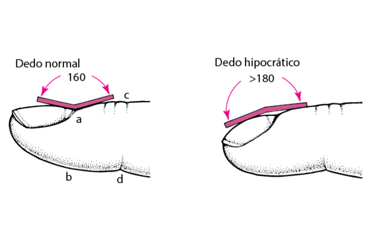 Acropaquia: la extraña forma de las uñas que podría ser signo de cáncer ...