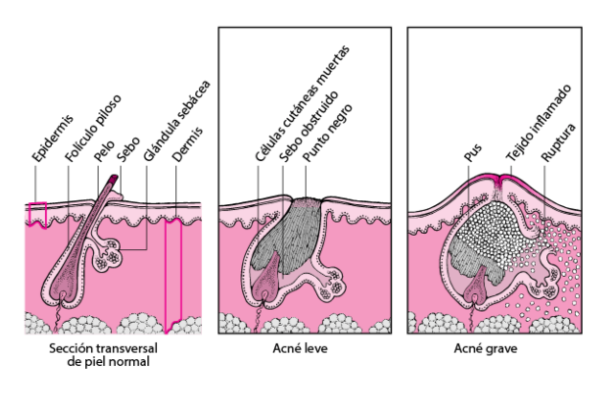 ¿Cómo identificar las causas del acné según la zona del rostro donde ...