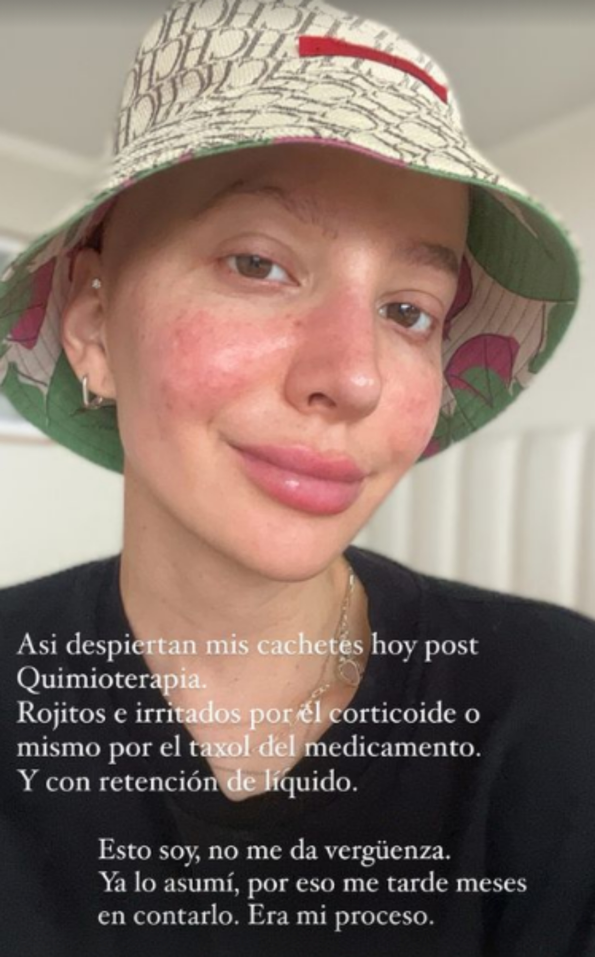 "Esta es mi piel realmente": Aylén Milla muestra su rostro al natural tras meses de ocultar su ...