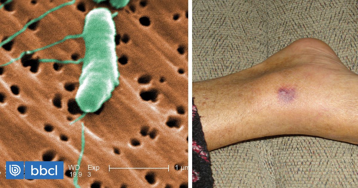 Qué es la bacteria carnívora: el patógeno "come carne" que se encuentra ...