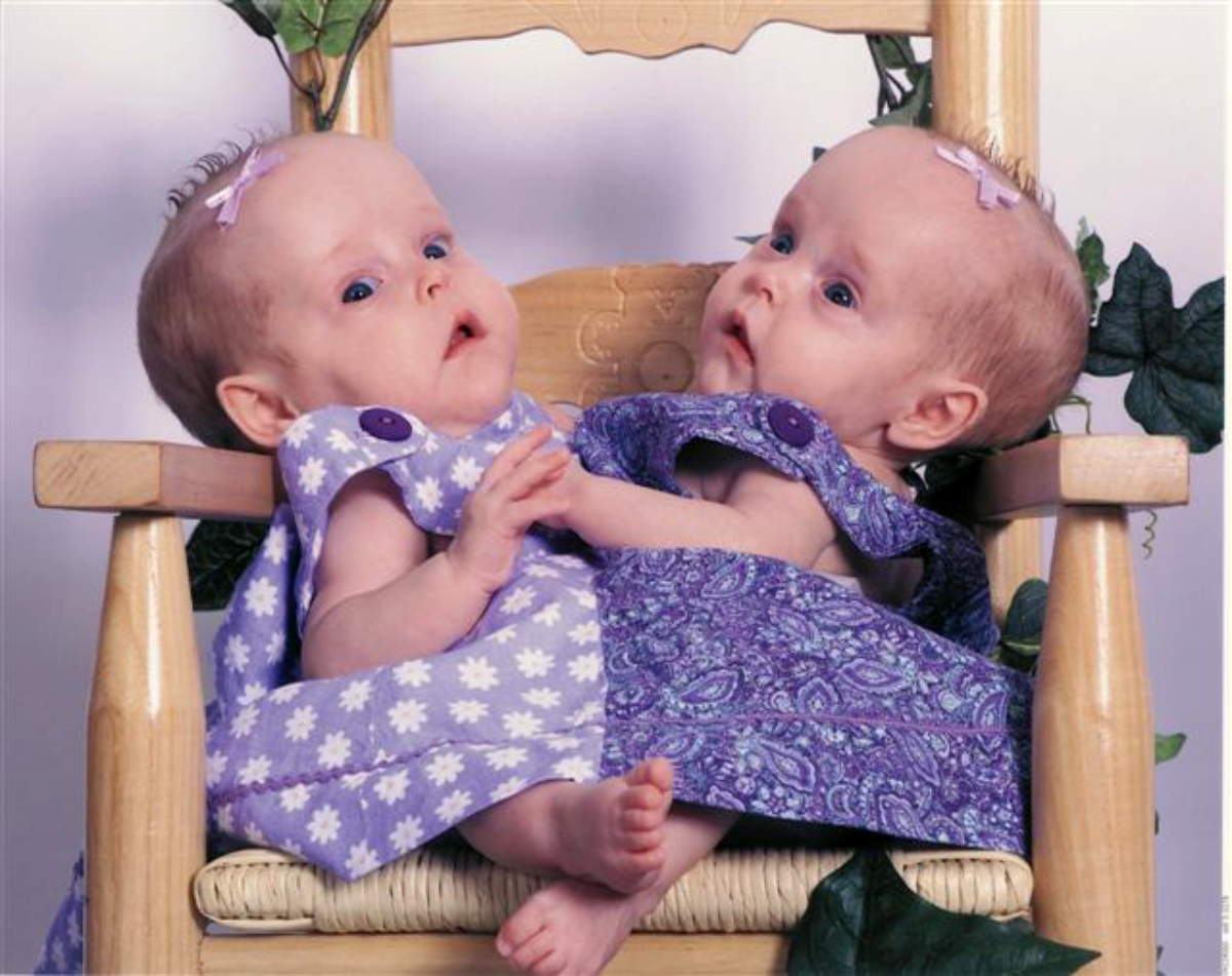 Unidas por el abdomen inseparables en todo: así viven Kendra y Maliyah ...