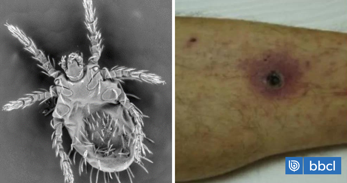 Confirman tres casos de contagio de "tifus de los matorrales" en Los Lagos