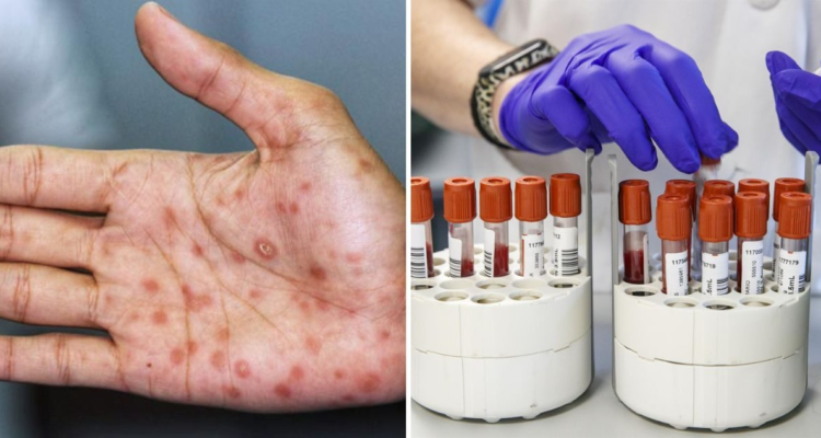 ¿Cuáles son los primeros síntomas de la Sífilis? Registran récord de ...