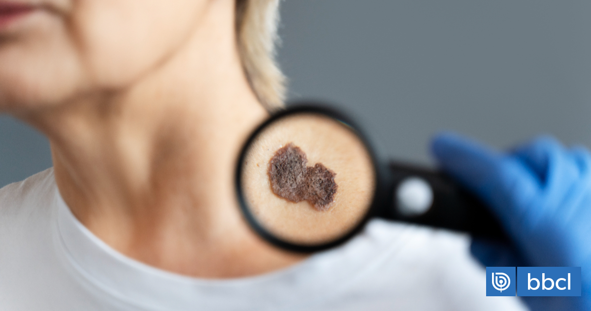Cuidarnos Juntos: ¿Qué es el melanoma? El cáncer que en 2020 dejó 324 ...