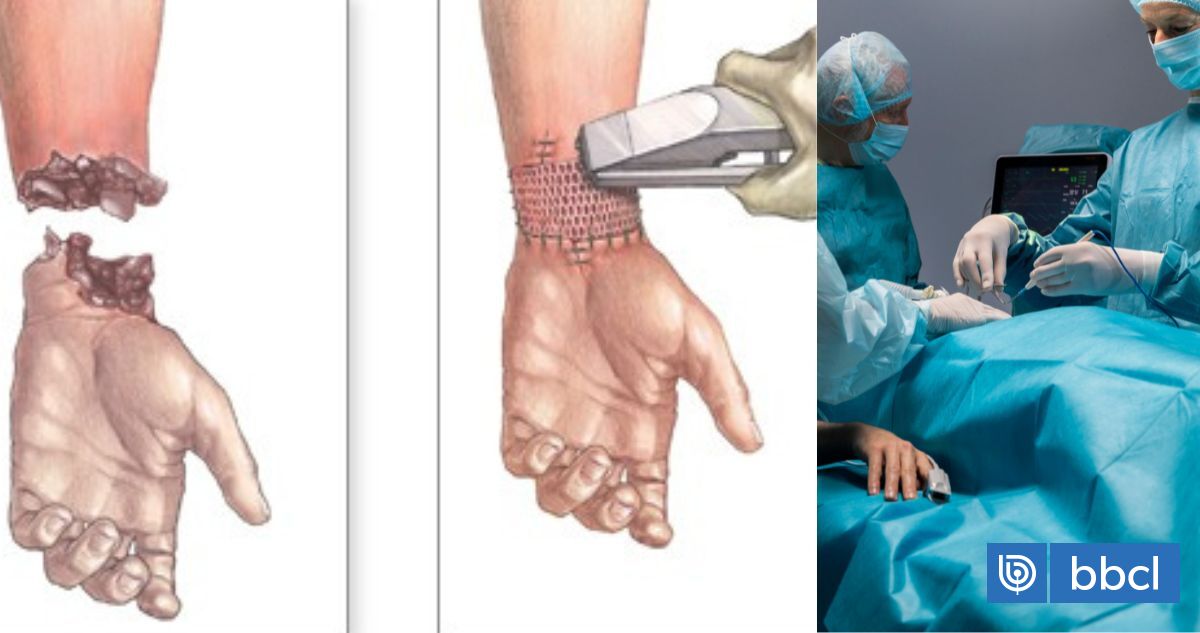 Cómo es la operación para reimplantar una extremidad amputada